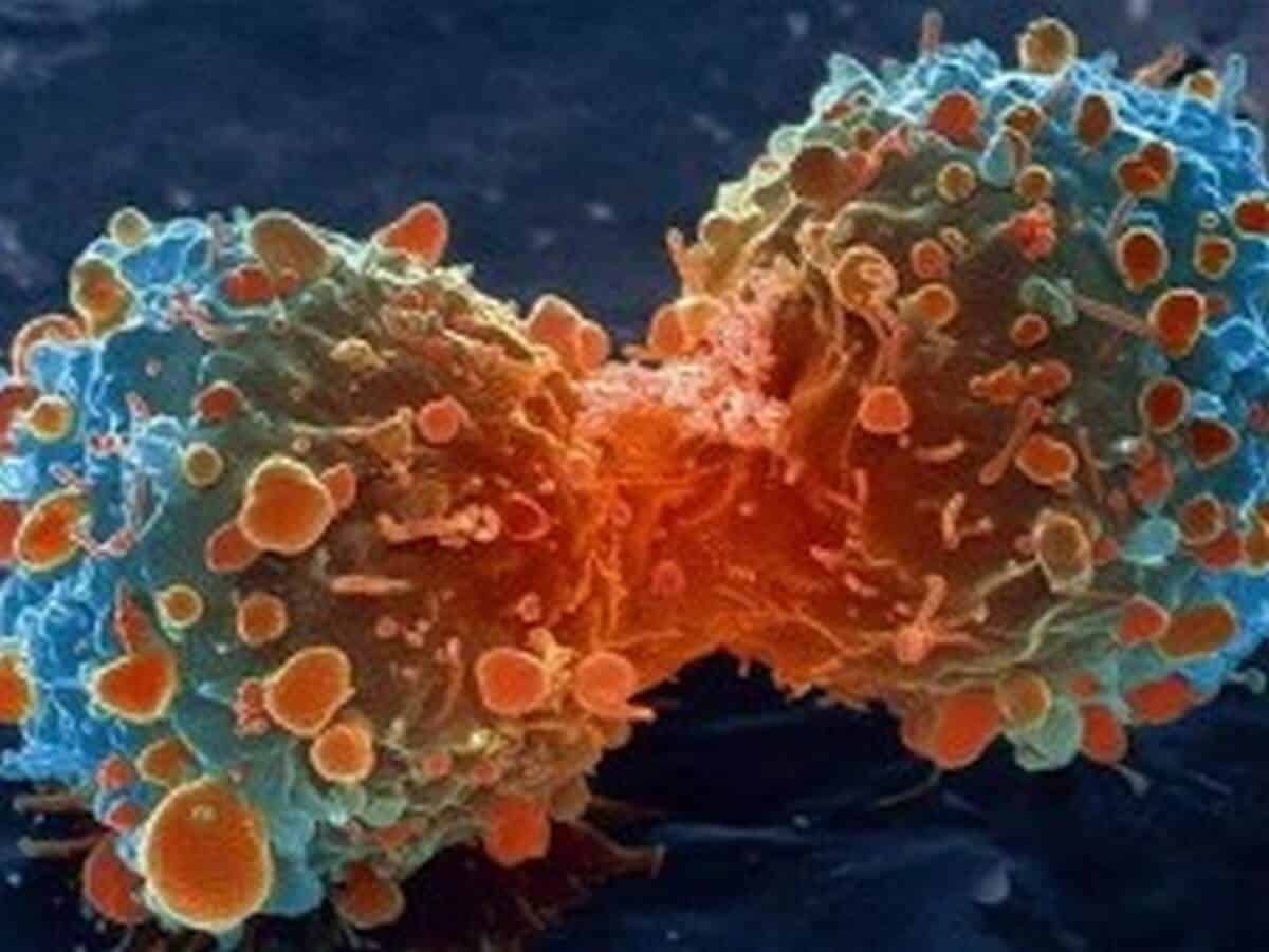 Lifestyle change and Cancer - MIO Hospital